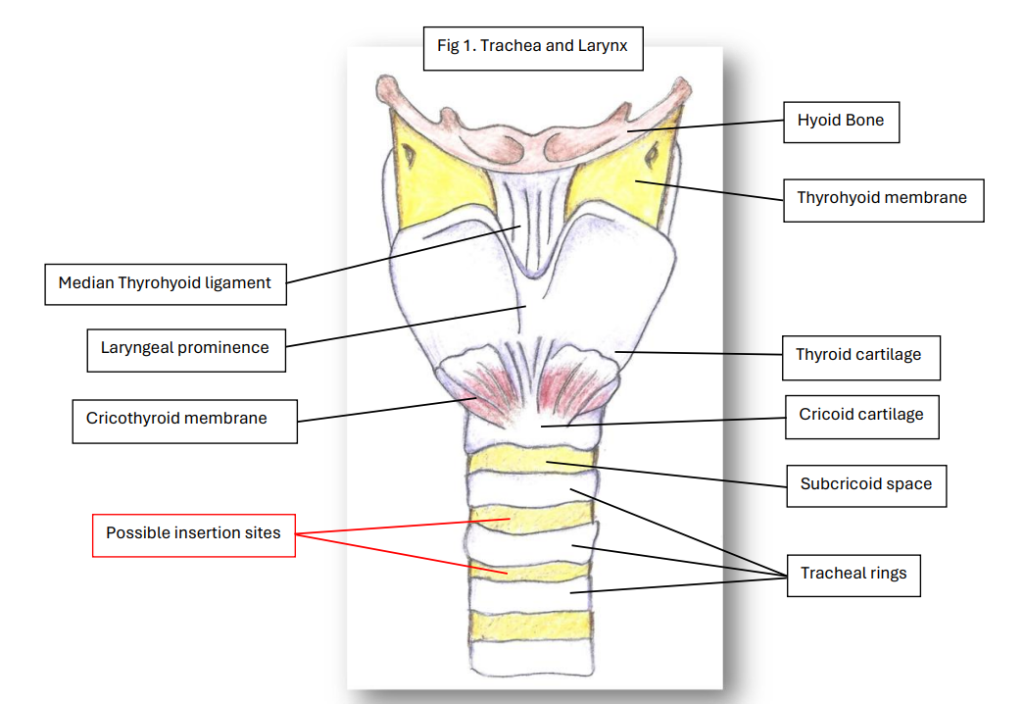 ‘The Tale of Tracheostomy’ - Focus on ABC approach to understand ...